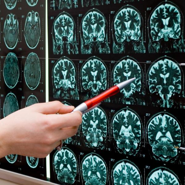 Epilepsy Society | Transforming lives through advocacy, research and care